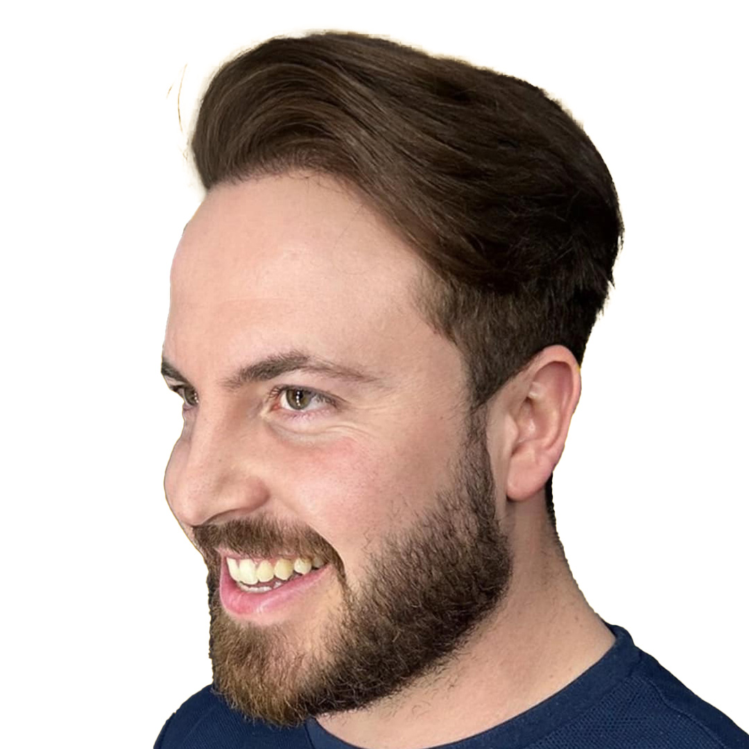 Gallery Hair Transplant Turkey | Turkeyana Clinic